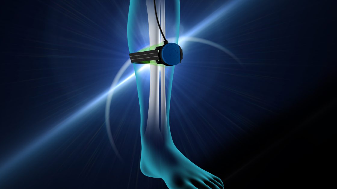 What Stimulates Bone Growth? | Orthofix Bone Growth Therapy