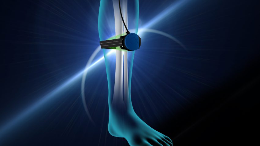 What Stimulates Bone Growth? | Orthofix Bone Growth Therapy